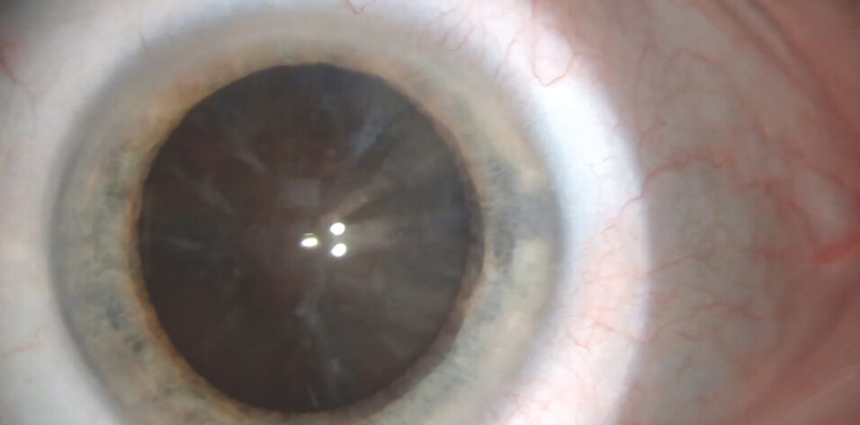 CRSToday | Dense Brunescent Unilateral Cataract