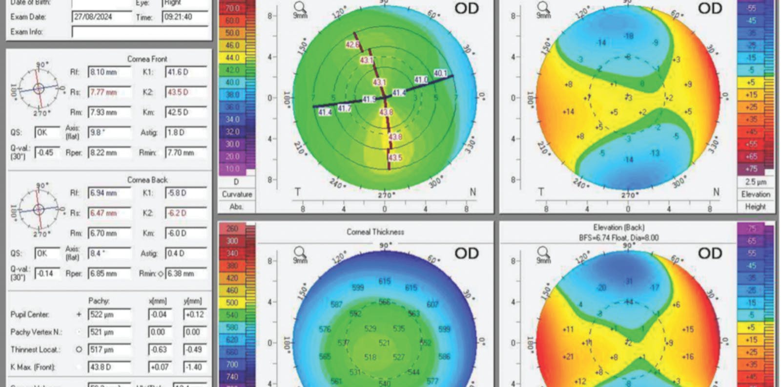 CRST Global | Anisometropia and a Unilateral Congenital Cataract
